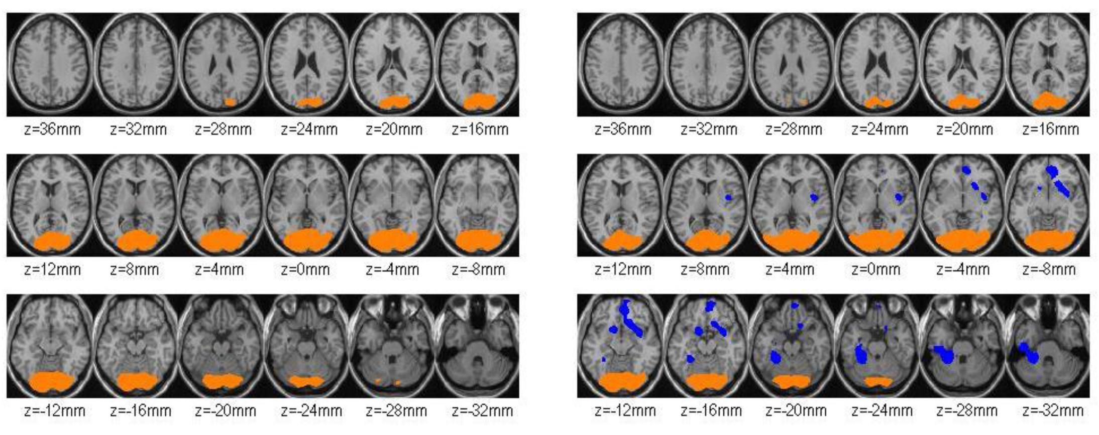 Brain Scans For Substance Abuse
