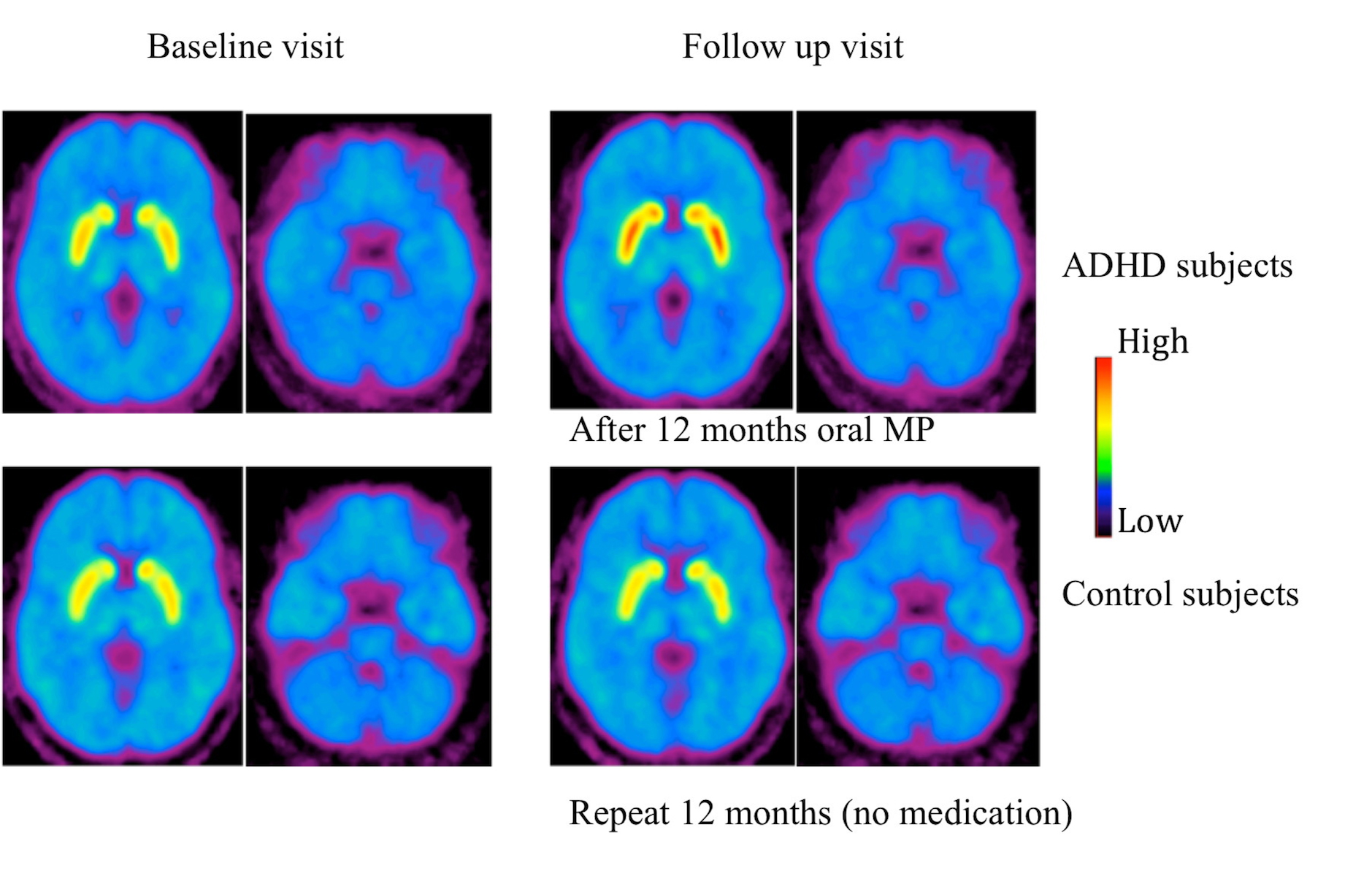 Long Term ADHD Treatment Increases Brain Dopamine Transporter Levels Long Term ADHD Treatment Increases Brain Dopamine Transporter Levels